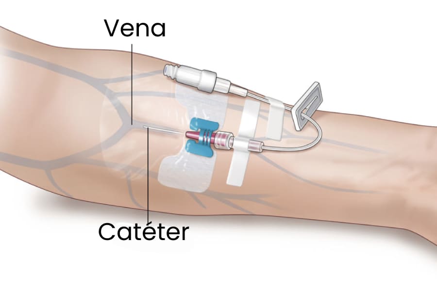 Colocación de catéter para hemodiálisis | CLÍNICA ANGIOCENTER |DR. MELVIN PARADA